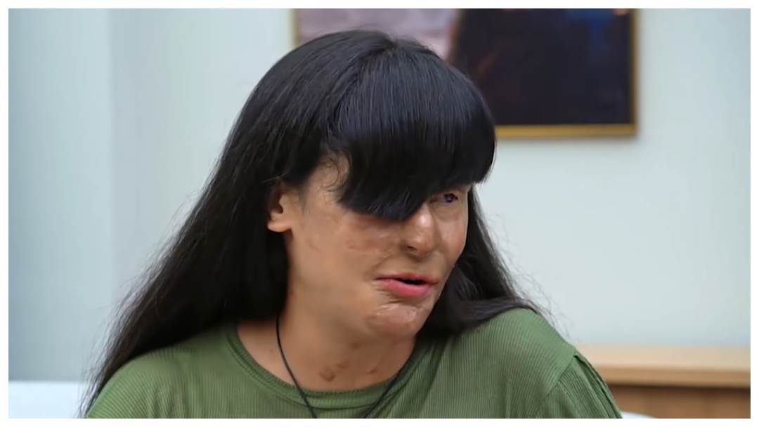 Žena koju je muž zalio kiselinom | Story