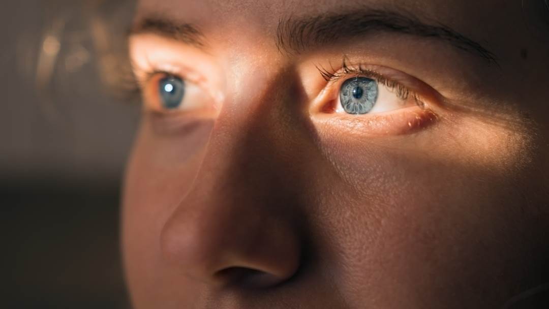 Simptomi kolesterola u oku i na koži oko nosa | Story