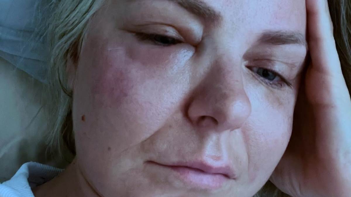 Stankica Stojanović objavila potresne fotografije svog lica | Story