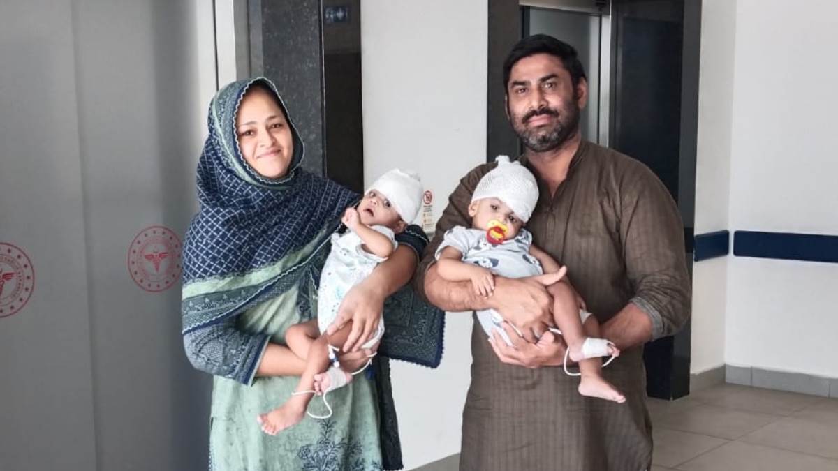 Kako izgledaju sijamske blizanke Minal i Mirha nakon razdvajanja? | Story