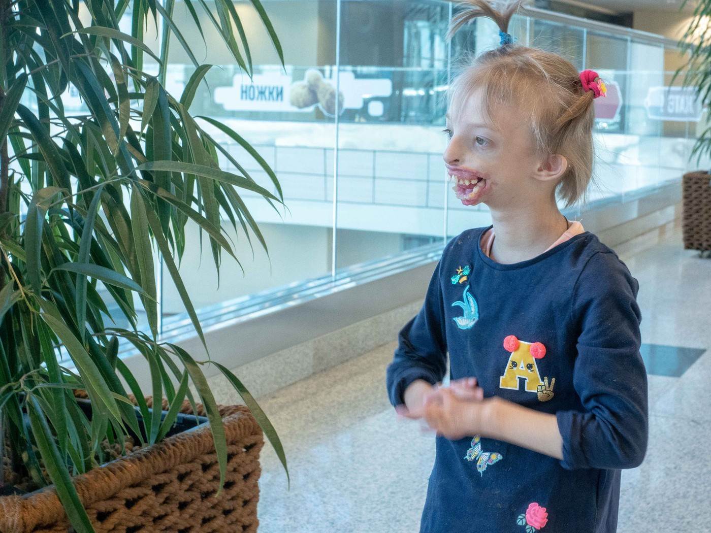 Kako danas izgleda djevojcica rodena bez pola lica? | Story