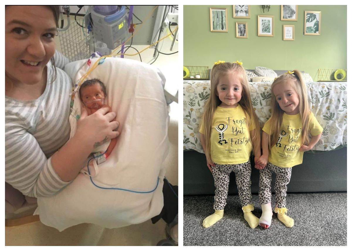 Blizanke rodene s rijetkom bolesti lomljivih kostiju | Story